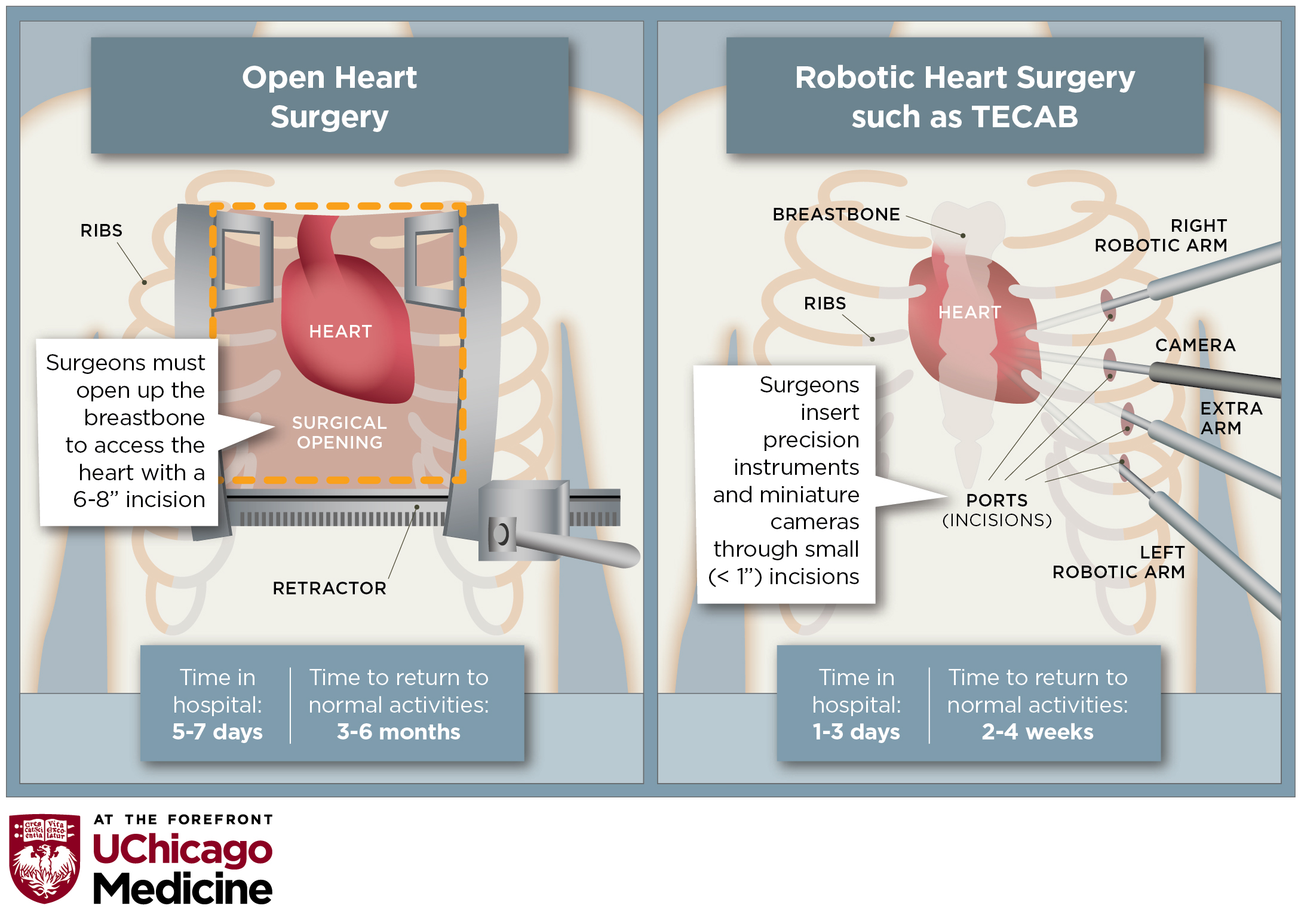 Expert Robotic Heart Surgery Care for Complex Conditions - UChicago ...
