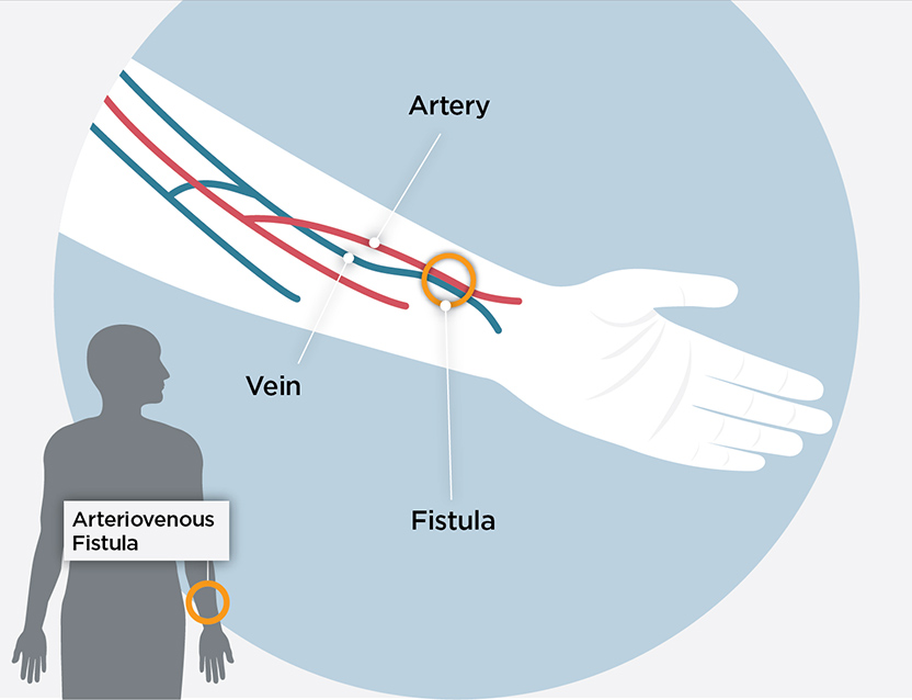 Kidney Dialysis Treatment - UChicago Medicine