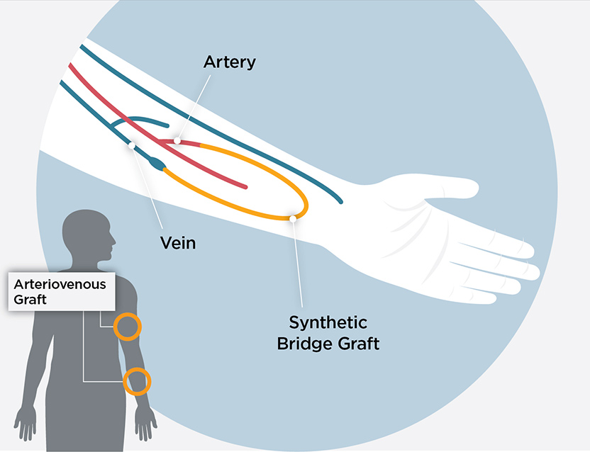Kidney Dialysis Treatment - UChicago Medicine