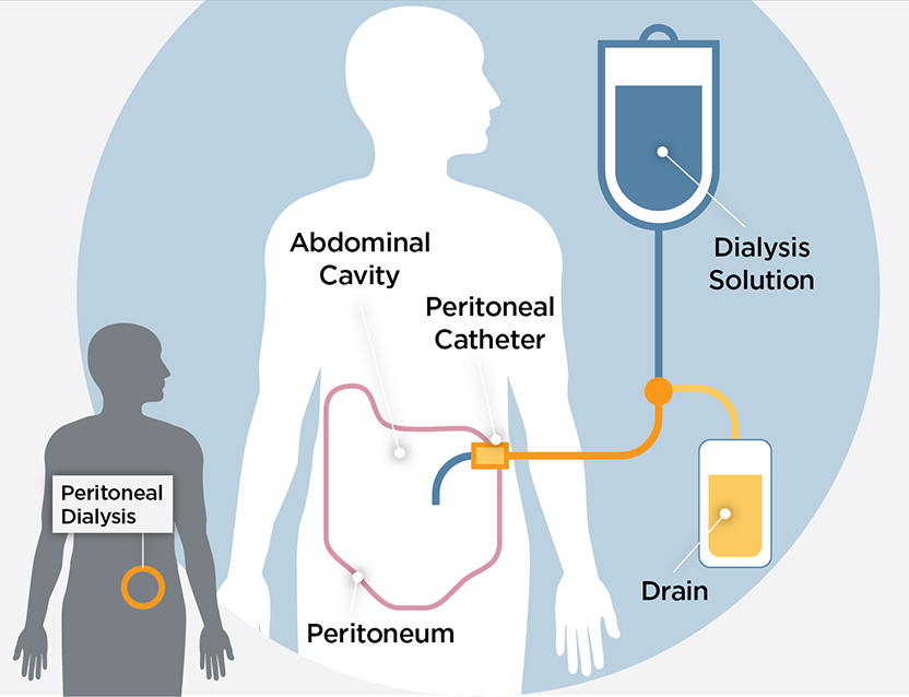 Kidney Dialysis Treatment - UChicago Medicine