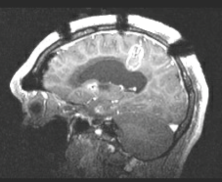 Stereotactic and Functional Neurosurgery - UChicago Medicine