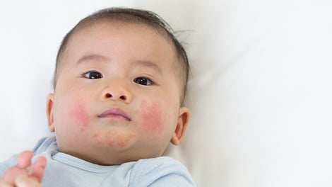 What is pediatric eczema, and when should we see a doctor? - UChicago ...