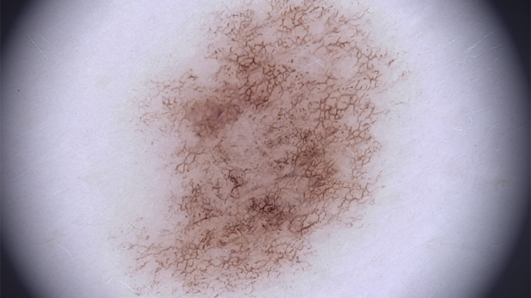 Mole Mapping - UChicago Medicine