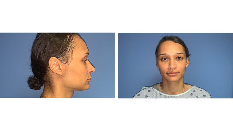 Parotidectomy Using a Facelift Incision - UChicago Medicine