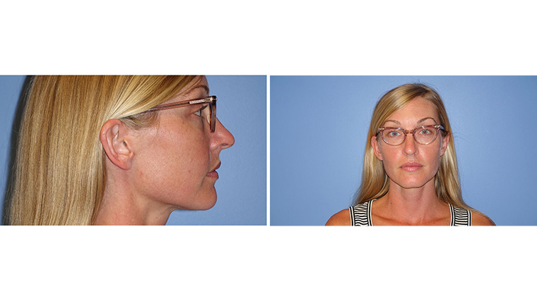 Parotidectomy Using a Facelift Incision - UChicago Medicine