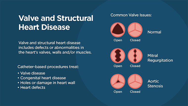 Transcatheter Procedures for Heart Valve Disease - UChicago Medicine