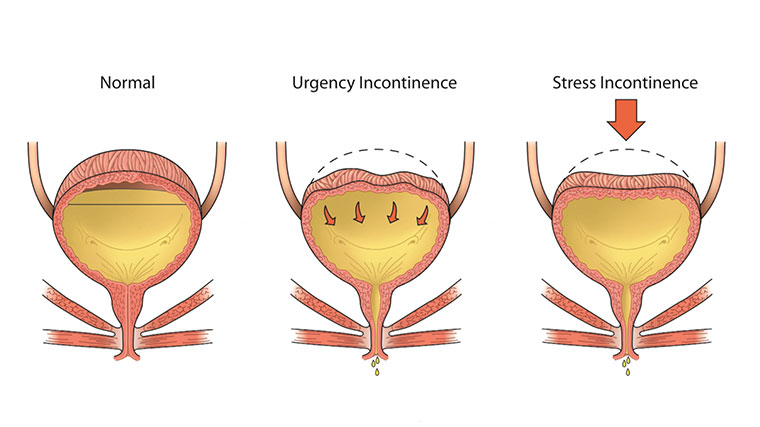 Pelvic Floor Disorders Uchicago Medicine