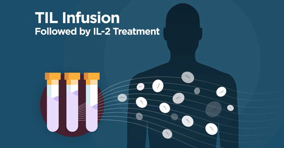 Cellular Therapy for Cancer - UChicago Medicine