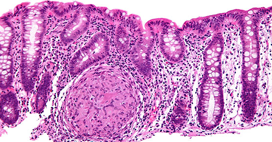 Pediatric IBD: Symptoms, Diagnosis and Treatment - UChicago Medicine