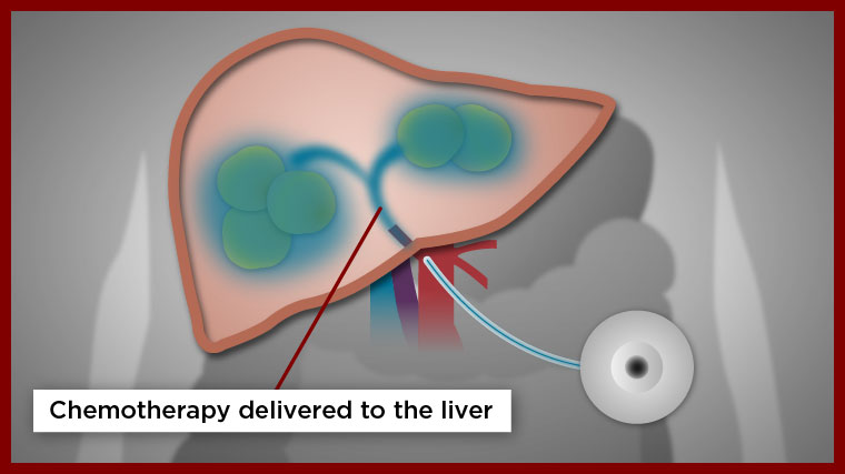 Hepatic Artery Infusion Pump - UChicago Medicine