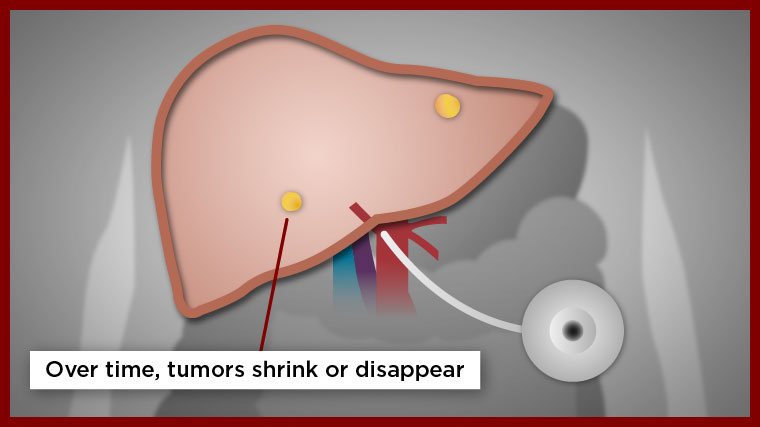 Hepatic Artery Infusion Pump Chemotherapy - UChicago Medicine