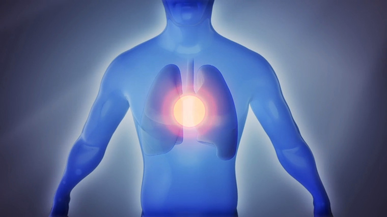 Advanced Emphysema - UChicago Medicine