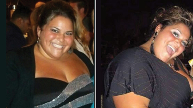 Bariatric Surgery for Obesity - UChicago Medicine