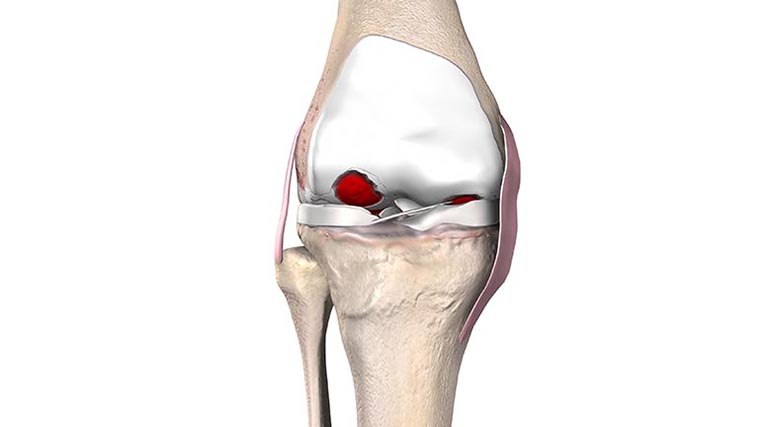 Knee Resurfacing Surgery - UChicago Medicine