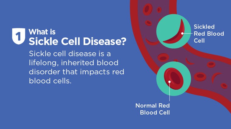 Sickle Cell Disease - UChicago Medicine