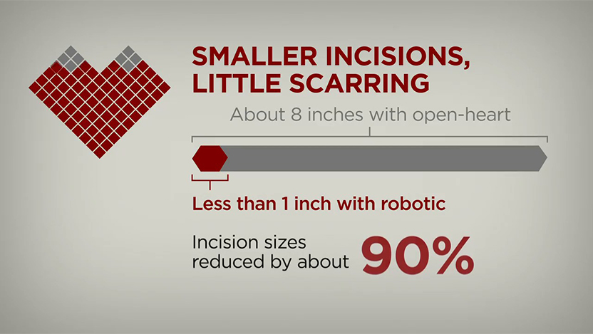 Expert Robotic Heart Surgery Care for Complex Conditions - UChicago ...